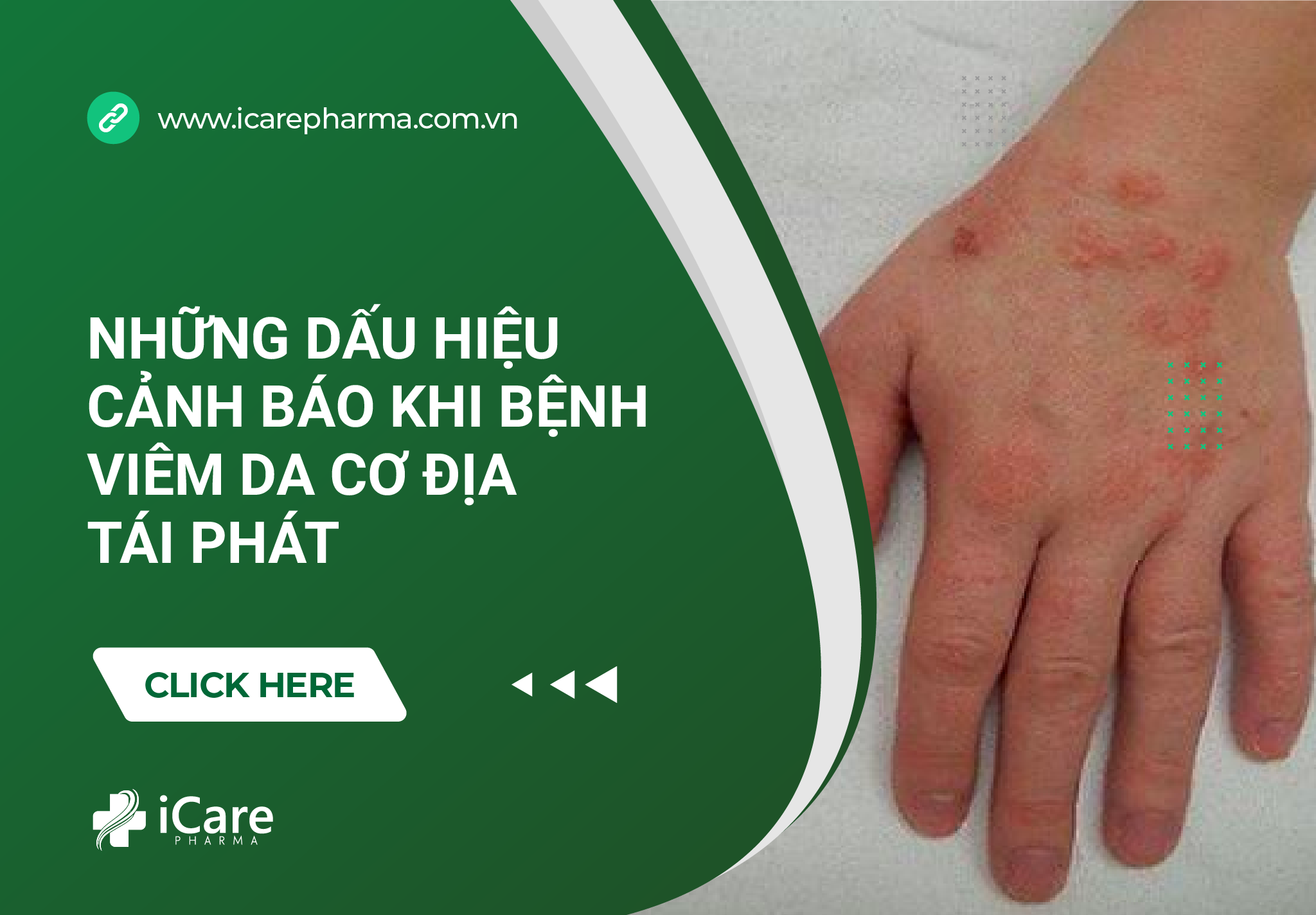 Những Dấu Hiệu Cảnh Báo Khi Bệnh Viêm Da Cơ Địa Tái Phát - iCare Pharma